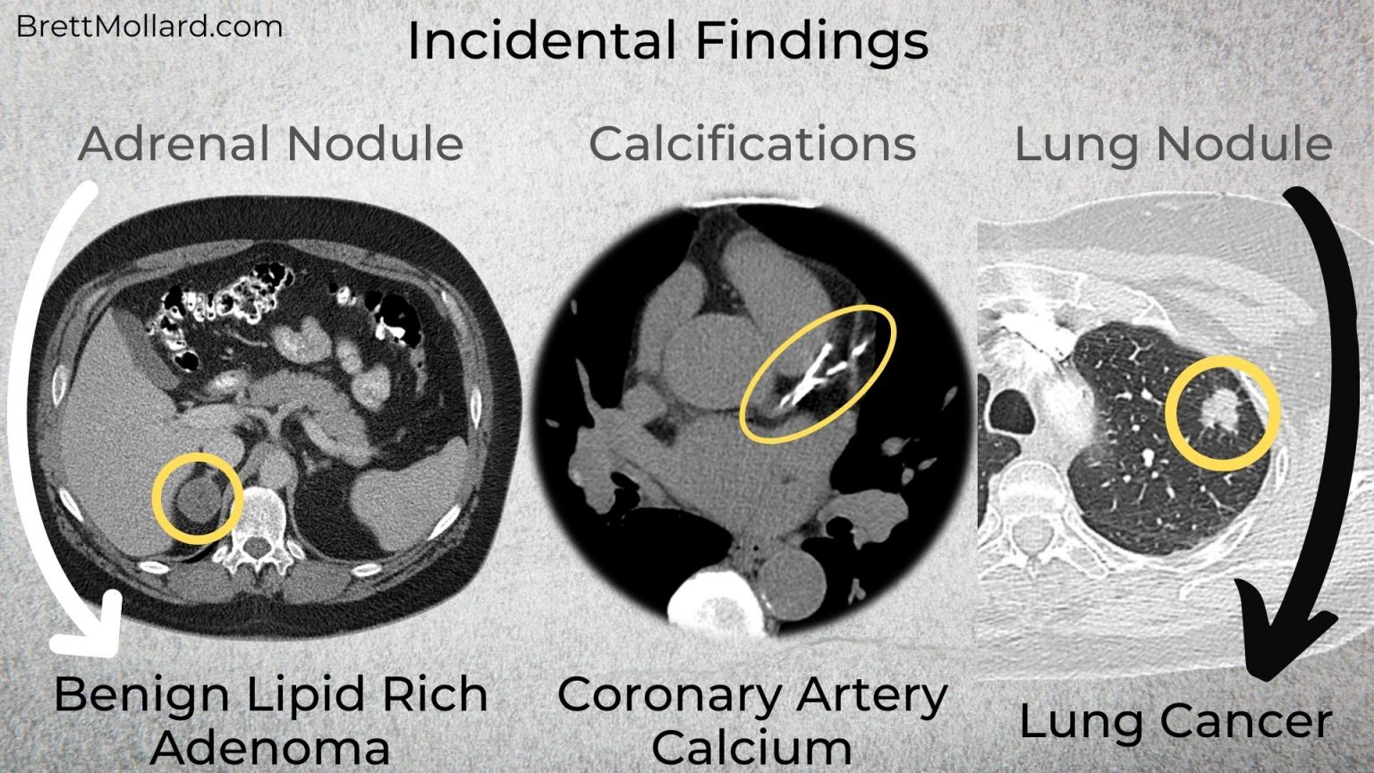 Everything You Want to Know About Incidental Findings - Brett Mollard