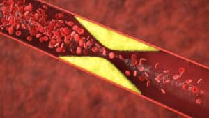 Nuclear Stress Test (Myocardial Perfusion Imaging) Demystified