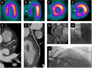 Nuclear Stress Test (Myocardial Perfusion Imaging) Demystified