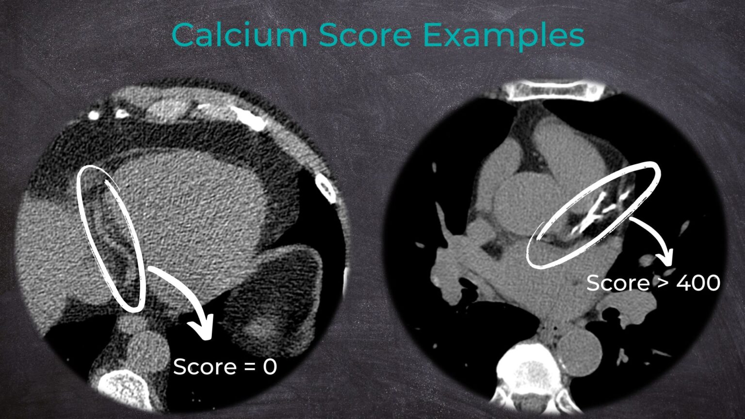 Why No Caffeine Before Calcium Scoring? Answered!