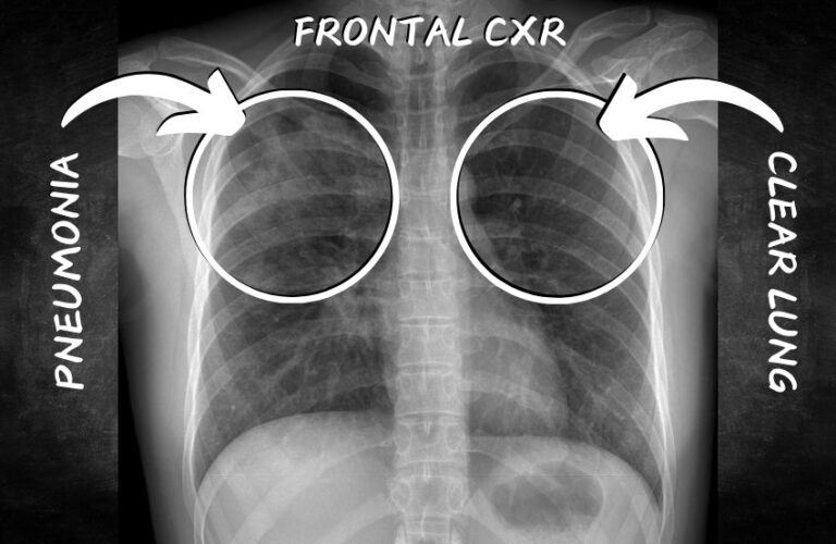 Chest X-ray Normal vs Abnormal: What Do Your Results Mean?